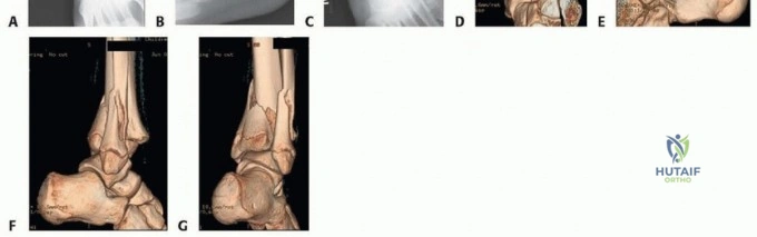 Pediatric Ankle Fractures: Avoiding Premature Physeal Closure